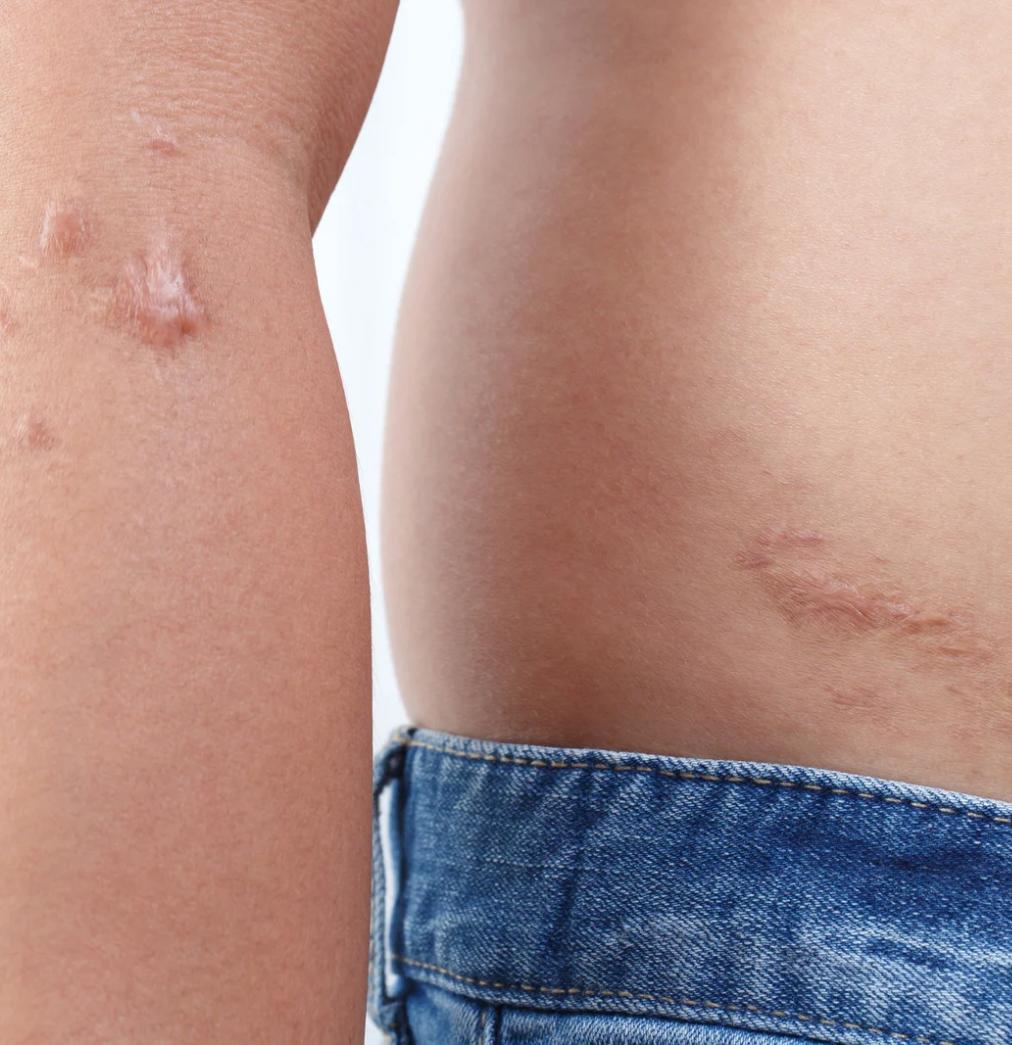 Keloid & Hypertrophic Scar - Vancoderm Academy