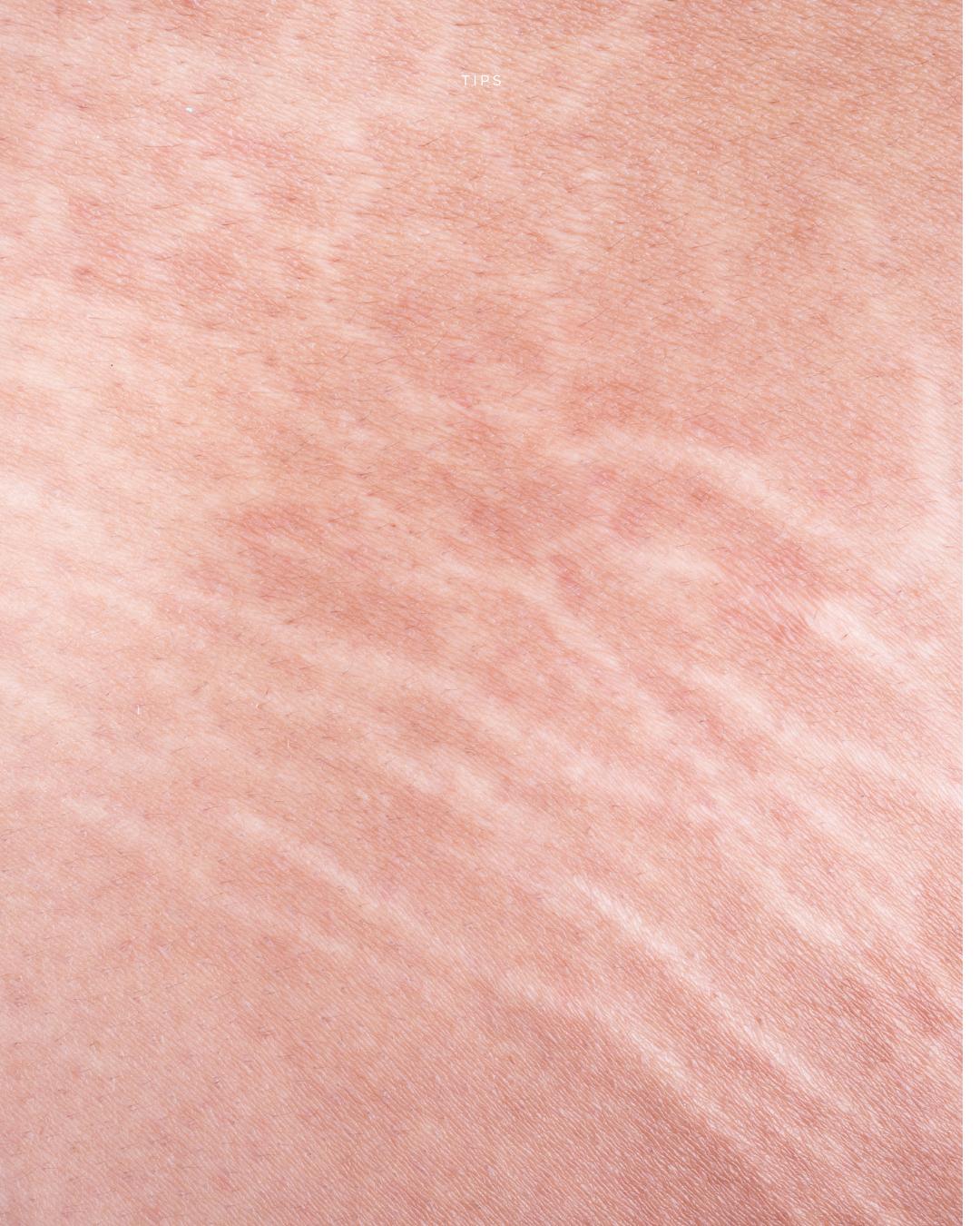 Stretch Marks and Skin Laxity After Weight Fluctuations and Pregnancy ...